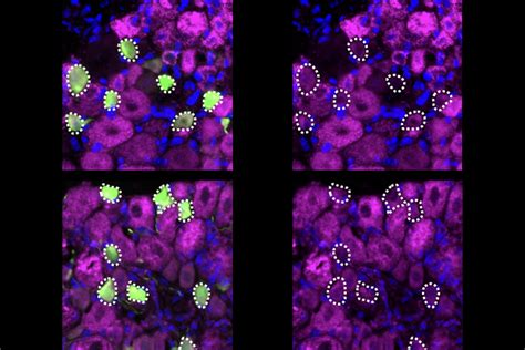 Synaptic Anomalies In Autistic People Support Imbalance Hypothesis The Transmitter