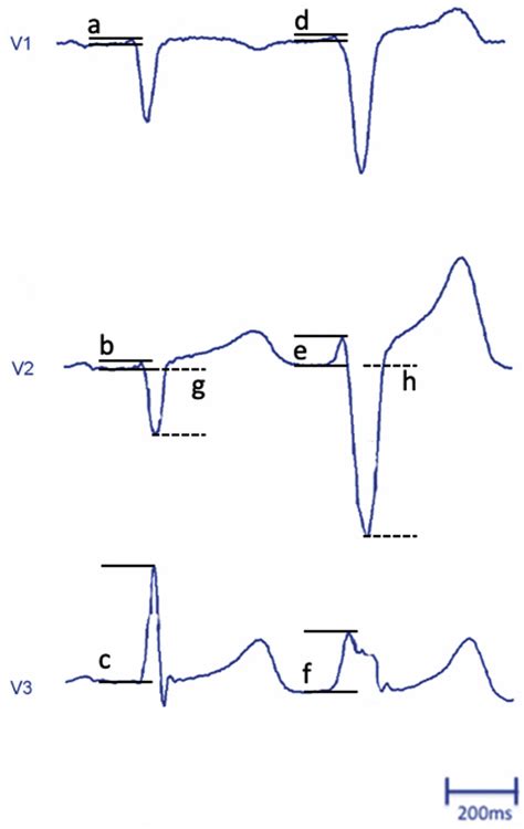 The Rv1 V3 Transition Ratio A Novel Electrocardiographic Criterion For The Differentiation Of