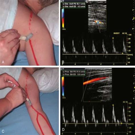 Usg Doppler Arterial And Venous Upper Limb Biilateral In Gurgaon Usg Doppler Arterial And Venous