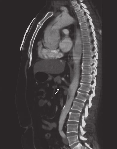 Ct Scan Acute Aortic Dissection Stanford Type A The Superior Download Scientific Diagram