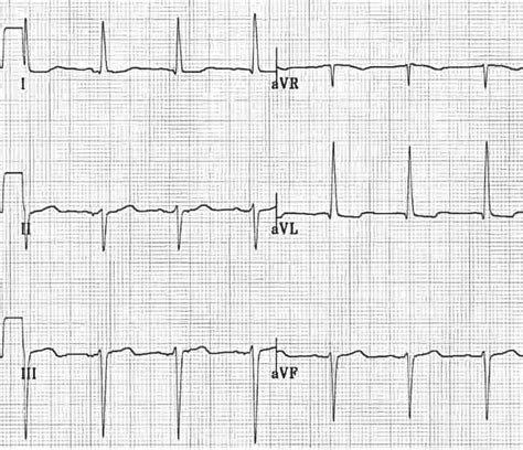 Left Anterior Fascicular Block Lafb • Litfl • Ecg Library Diagnosis