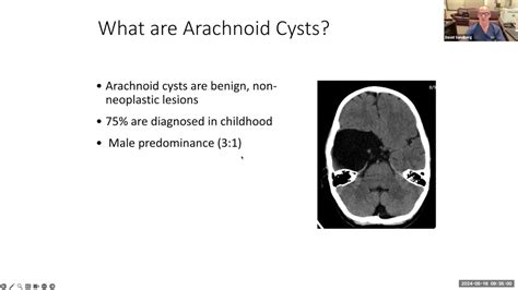 Subarachnoid Cyst Spinal Meningitis