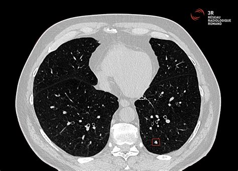 Scanner Aide Au Diagnostic Du Cancer Du Poumon Avec Lia Chez 3r