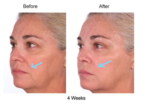 Gelatin For Skin Tightening Best Natural Solution