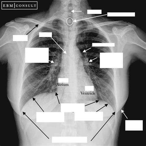 Cxr Image 1 Diagram Quizlet
