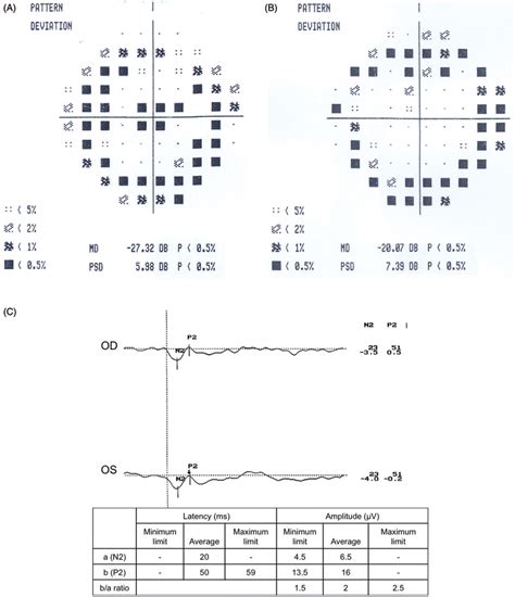 Pattern Deviation Plots Of Visual Field Testing With 30 2 Swedish