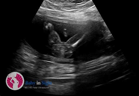 Gender Reveal Ultrasound