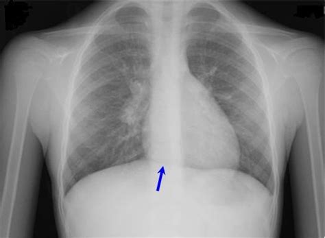On Radiology Continuous Diaphragm Sign Of Pneumomediastinum And