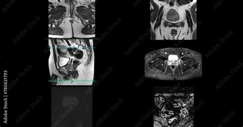 Mri Of The Prostate Gland Reveals A 2 0x0 9x1 7 Cm Malignant Prostate Tumor At Left Posterior Pz
