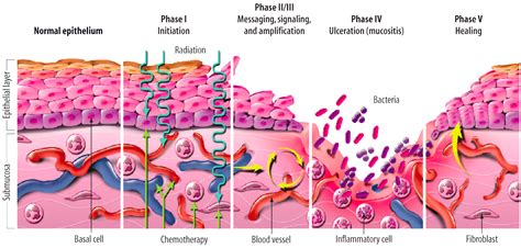Oral Mucositis On Emaze