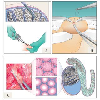 Sperm Retrieval Methods A Testicular Sperm Aspiration The Download Scientific Diagram