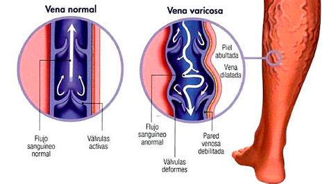 Espacio Médico Vascular Para La Id Y Manejo De La Tvp Diariomedico