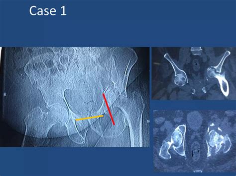 Acetabular Defects Pptx