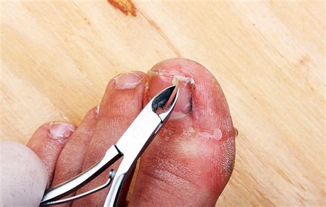 The Most Common Toenail Problems