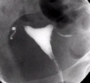 Hysterosalpingogram Hsg X Ray For Infertility Fertility Treatment Center