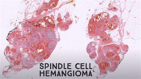 Spindle Cell Hemangioma Treatment At Alice Pace Blog