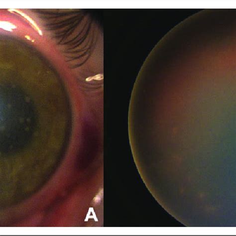 A Diffuse Choroidal Hemangioma Of The Left Eye B Choroidal Download Scientific Diagram