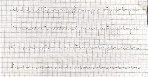 Qtc Prolongation And Hypocalcemia A Deep Dive