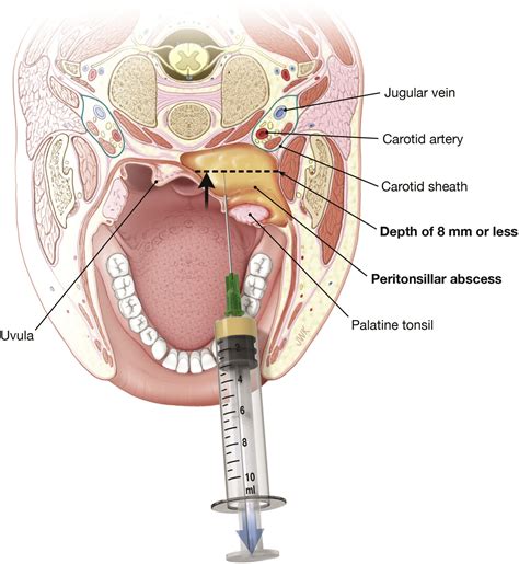 Adult Patients With Peritonsillar Abscess What Nurse Practitioners In