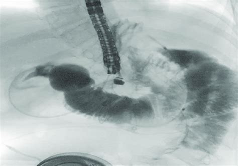 Gastrojejunostomy Is Completed Contrast Medium Passes Through The Download Scientific Diagram