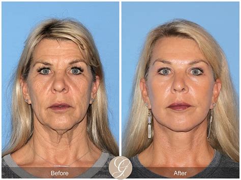 Before And After Face Procedures In Newport Beach Ca Orange County Facial Plastic Surgeon