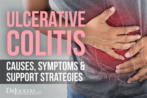 Ulcerative Colitis Symptoms