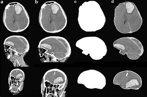 Automated Detection Of Fatal Cerebral Haemorrhage In Postmortem Ct Data International Journal