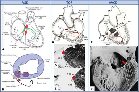 Conduction In… The American Association For Thoracic Surgery Aats