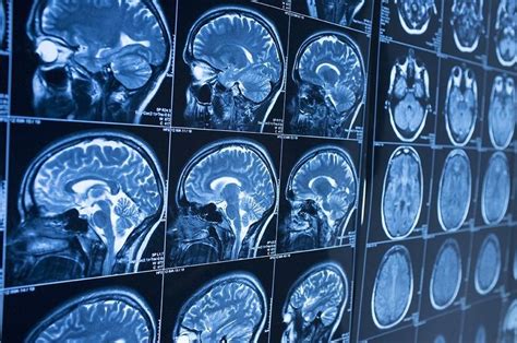 Segmentação De Imagens Médicas Com Deep Learning