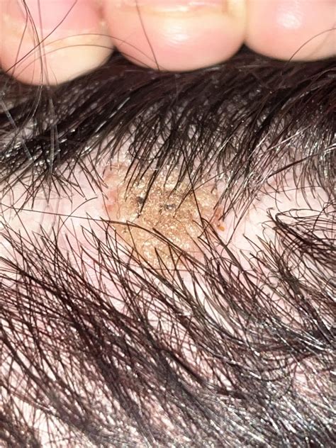 Scalp Lesion R Dermatologyquestions