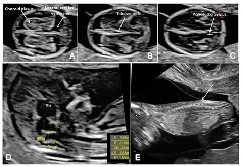First Trimester Ultrasound Detection Of Fetal Central Nervous System Anomalies