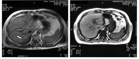 Metastatic Disease In The Liver Left And Complete Response After Download Scientific Diagram