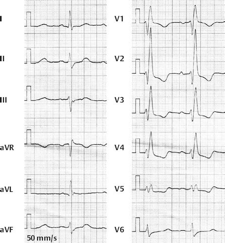 Right Bundle Branch Block Thoracic Key