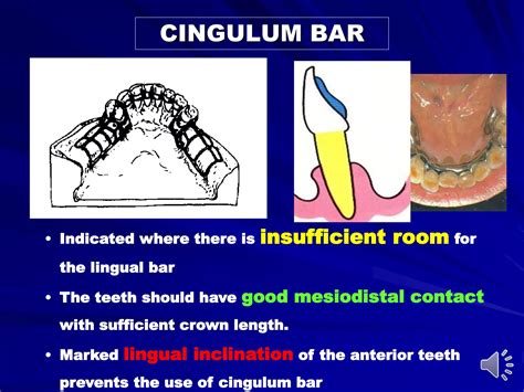 Mandibular Major Connectors And Minor Connectors Ppt