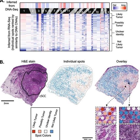 Copy Number Alterations Are Detectable In Spatial Transcriptomics Data