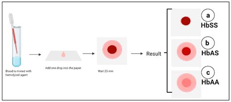 Sickle Cell Test What Is Sickle Cell Disease Vitrosens