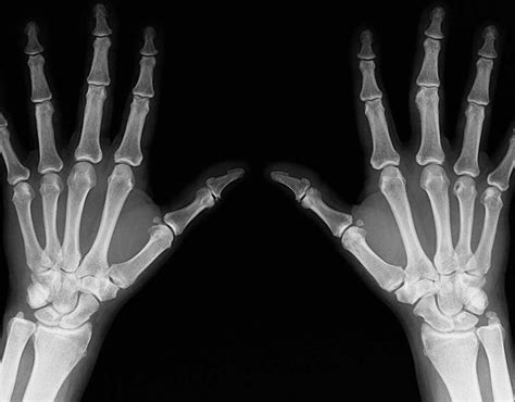 Bone Spurs On Fingers Causes Symptoms Treatments And Prevention