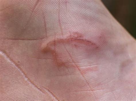 Vietnam Hookworm Warning Woman Contracts Parasite From Hoi An Beach News Com Au Australias