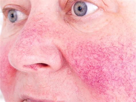 11 Skin Bumps That Look Like Pimples But Arent