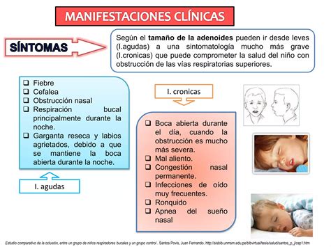 Rinitis Adenoiditis Sinusitis Croup Pptx