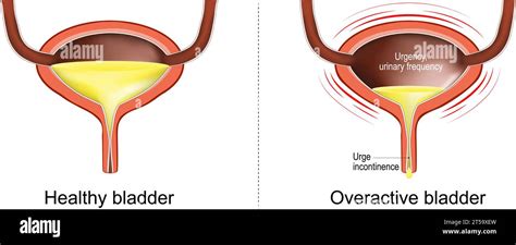 Overactive Bladder Loss Of Bladder Control Urge Incontinence Signs And Symptoms Of A Bladder
