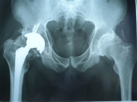 Darko Talevski On Linkedin Revision Using Gription Augmentation For