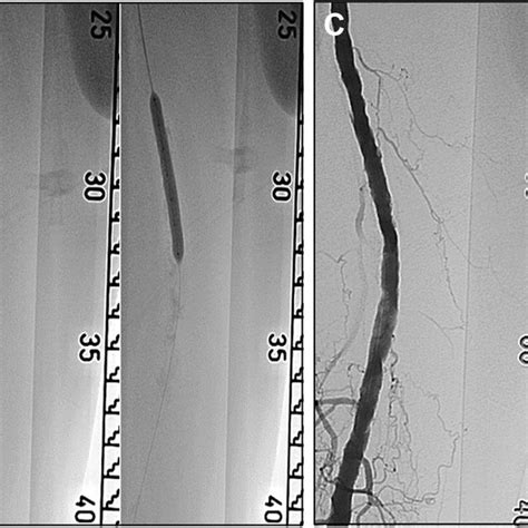 Pdf Intravascular Lithotripsy For Peripheral Artery Calcification