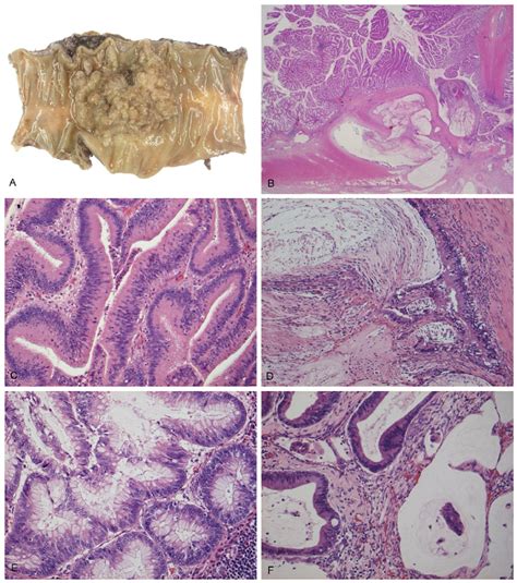 A A Polypoid Mass With A Villous Structure Is Seen On The Surface Of