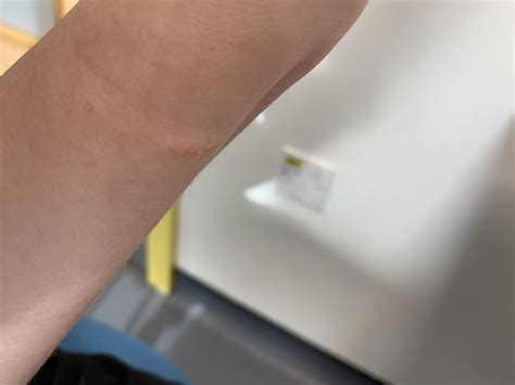 Rash From Wearing Watch R Garmin