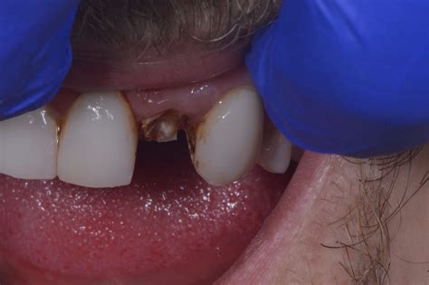 Gergis Size 1 Dme Matrix Brickworks Dental