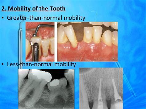 Tooth Extraction Exodontia Definition Methods Of Extraction Intraalveolar
