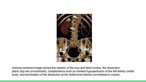 Aortic Dissectionpptx