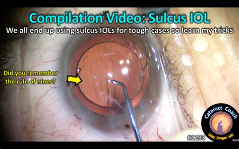 1293 Compilation Video Sulcus Iol Cataract Coach
