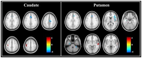 Brain Regions Showing Significant Differences In Corticostriatal Download Scientific Diagram